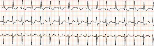 Arrhythmia (Review)