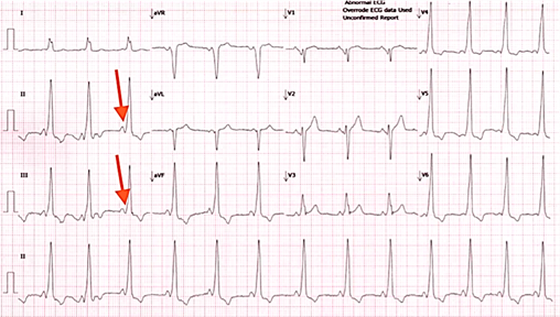 Arrhythmia (Review)