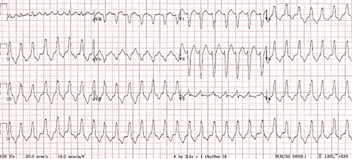 Arrhythmia (Review)