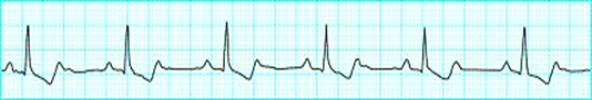 Arrhythmia (Review)