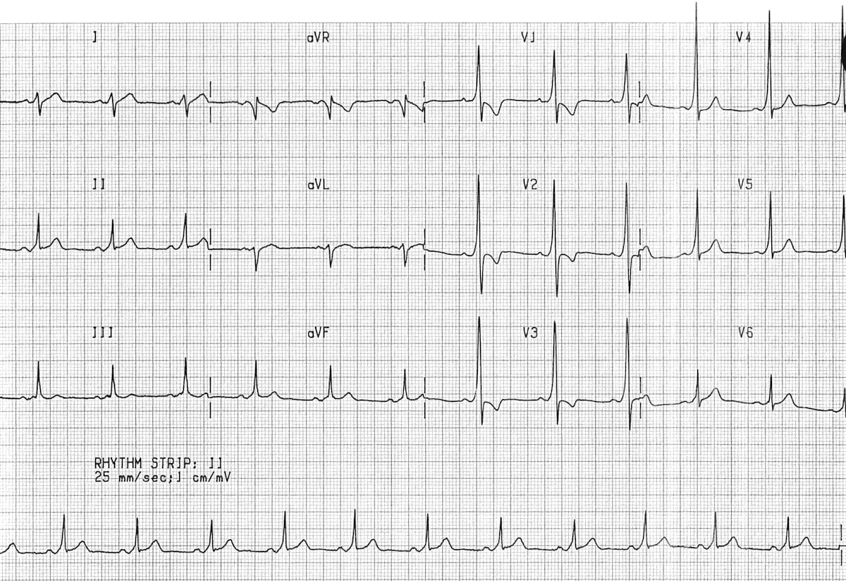 Arrhythmia (Review)
