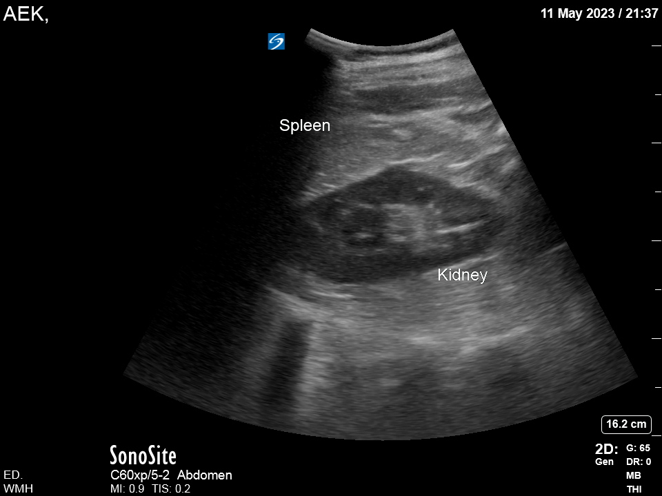 Point of care ultrasound (POCUS)