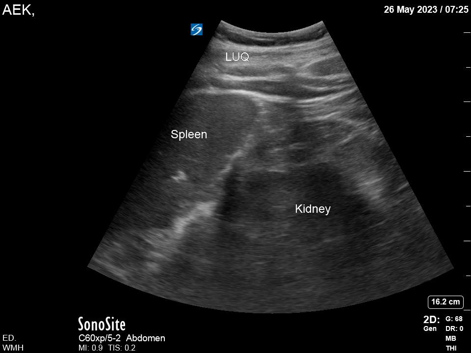 Point of care ultrasound (POCUS)