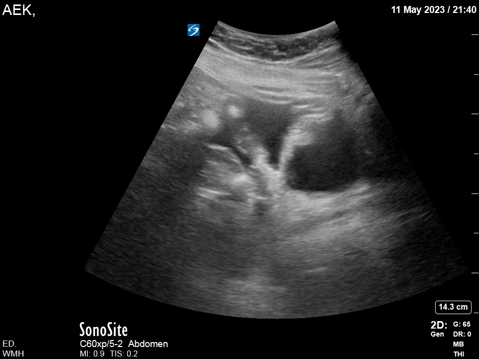 Point of care ultrasound (POCUS)