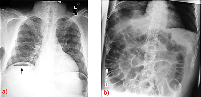 Bowel / viscus perforation