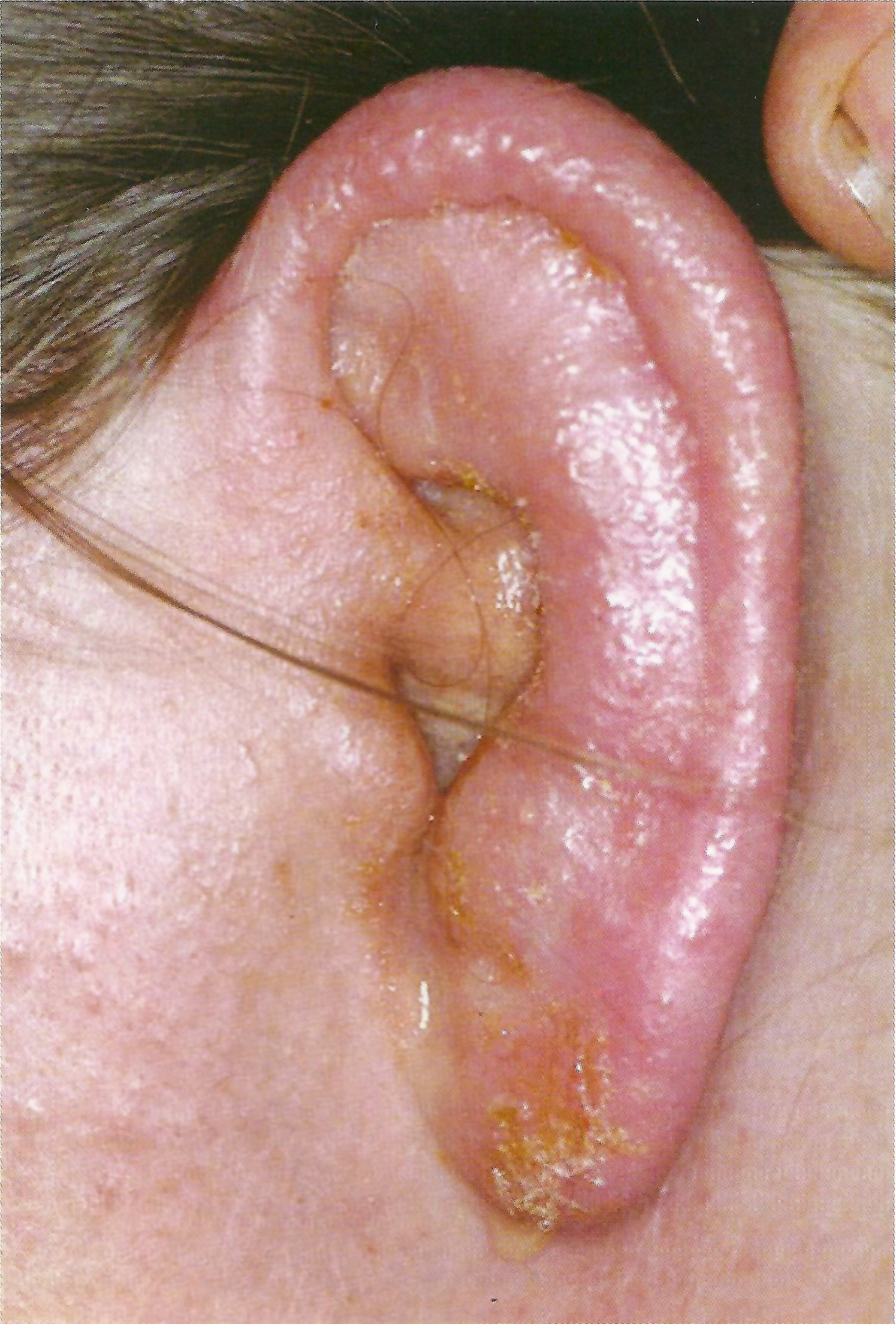 Acute Otitis externa