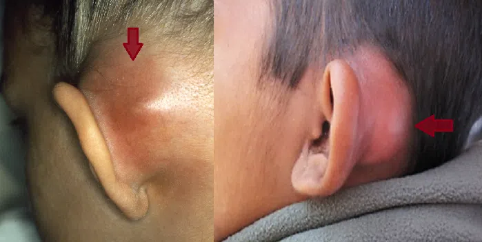 Acute Mastoiditis ‎ - FRCEM Secrets