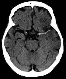 Acute ischaemic Stroke