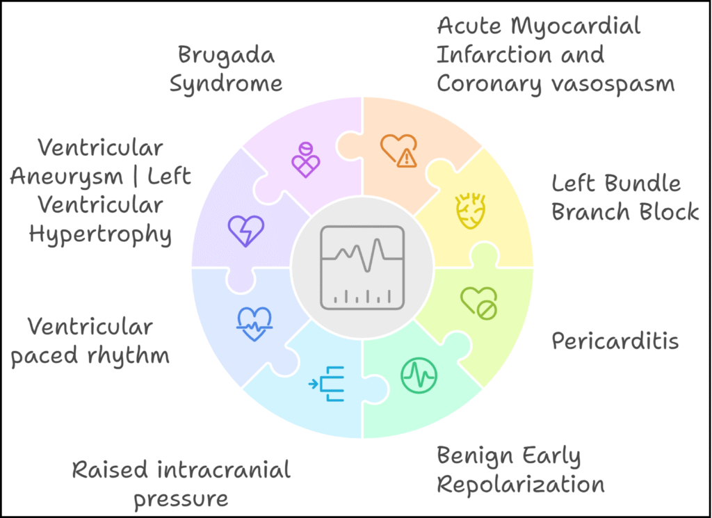 STEMI Mimics ECGs